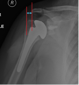 Post-Operative Radiographic Assessment - Shoulder Arthroplasty Book