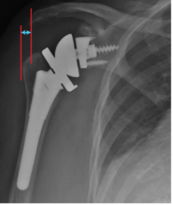 Post-Operative Radiographic Assessment - Shoulder Arthroplasty Book