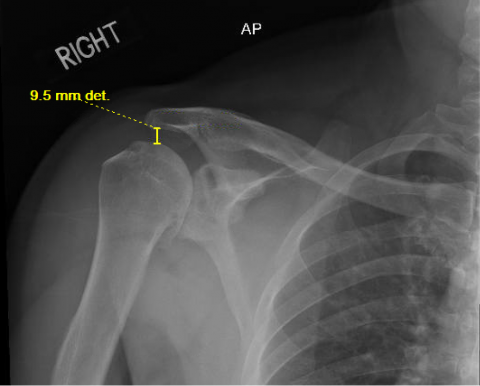 Pre-Operative Radiographic Assessment - Shoulder Arthroplasty Book