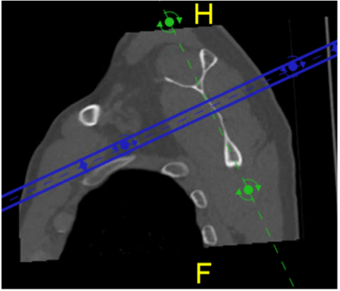 Pre-Operative Radiographic Assessment - Shoulder Arthroplasty Book
