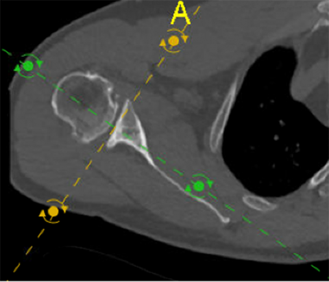 Pre-Operative Radiographic Assessment - Shoulder Arthroplasty Book