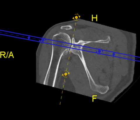 Pre-Operative Radiographic Assessment - Shoulder Arthroplasty Book