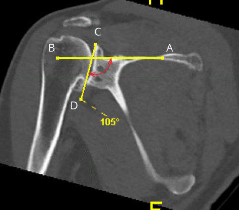 Pre-Operative Radiographic Assessment - Shoulder Arthroplasty Book
