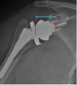 Post-Operative Radiographic Assessment - Shoulder Arthroplasty Book