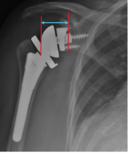 Post-Operative Radiographic Assessment - Shoulder Arthroplasty Book