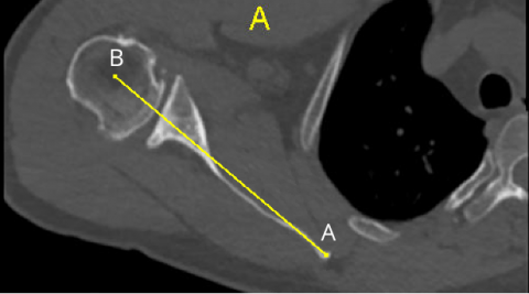 Pre-Operative Radiographic Assessment - Shoulder Arthroplasty Book