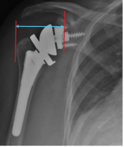Post-Operative Radiographic Assessment - Shoulder Arthroplasty Book