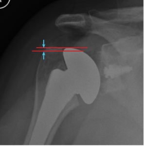 Post-Operative Radiographic Assessment - Shoulder Arthroplasty Book