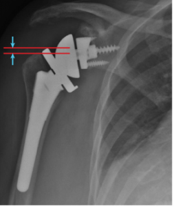 Post-Operative Radiographic Assessment - Shoulder Arthroplasty Book