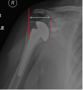 Post-Operative Radiographic Assessment - Shoulder Arthroplasty Book