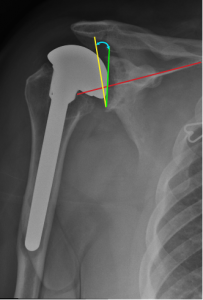 Post-Operative Radiographic Assessment - Shoulder Arthroplasty Book