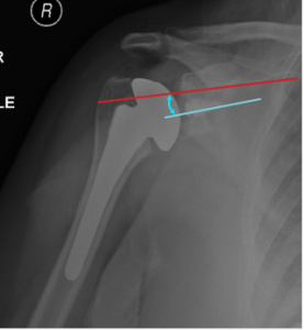 Post-Operative Radiographic Assessment - Shoulder Arthroplasty Book