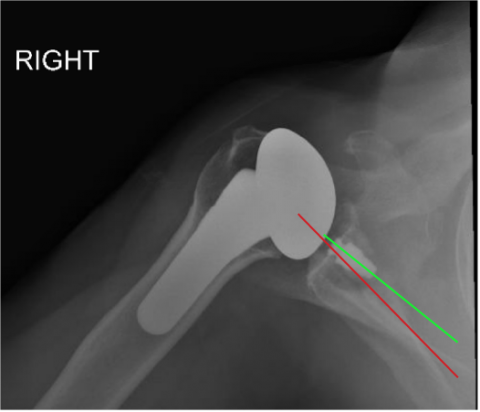 Post-Operative Radiographic Assessment - Shoulder Arthroplasty Book