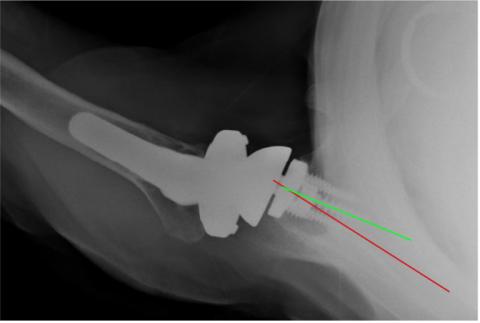 Post-Operative Radiographic Assessment - Shoulder Arthroplasty Book