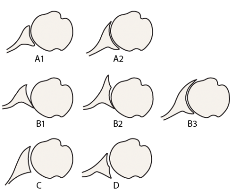 Introduction - Shoulder Arthroplasty Book